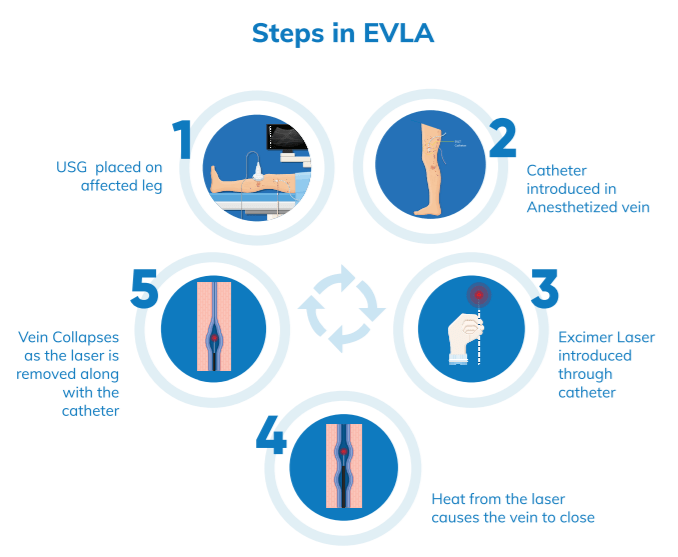 What is EVLA? Benefits of Laser Treatment for Varicose Veins - Medfin
