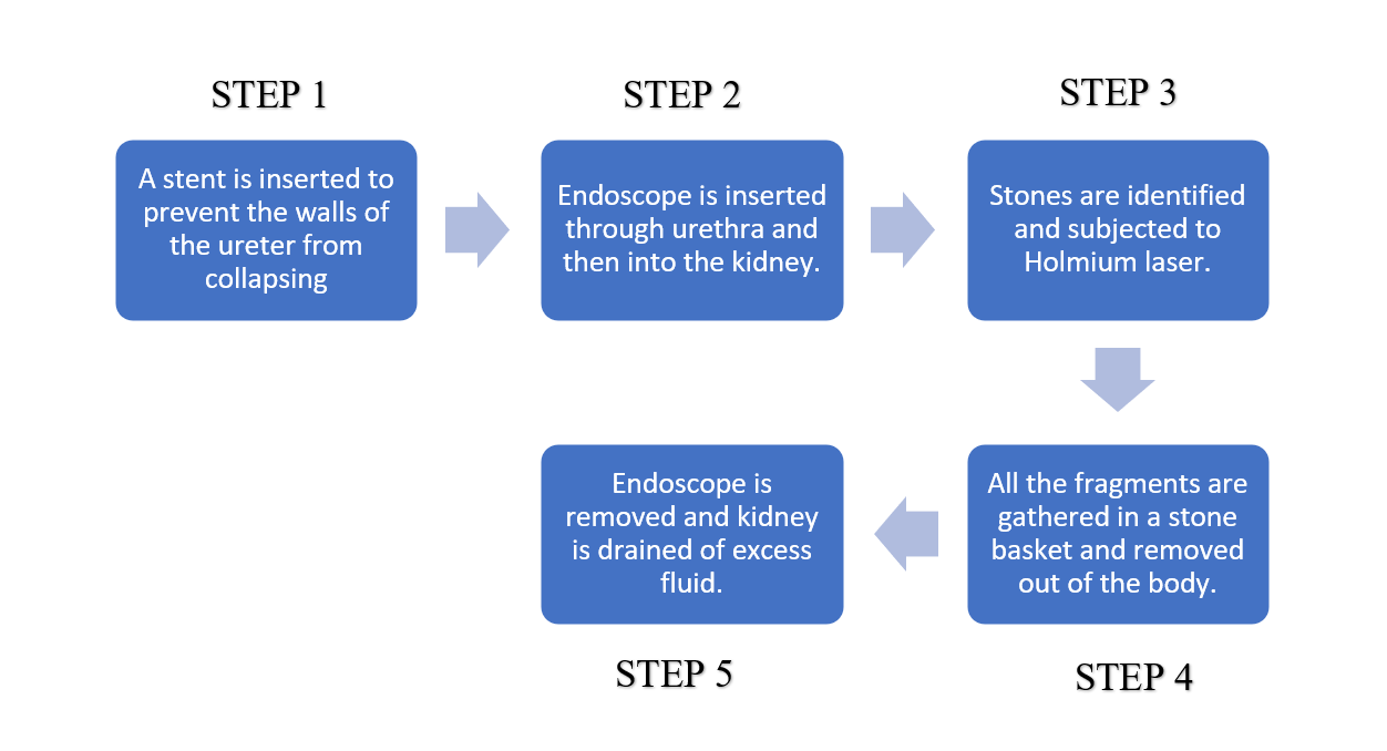 What is RIRS? Is It a Reliable Kidney Stone Laser Surgery?