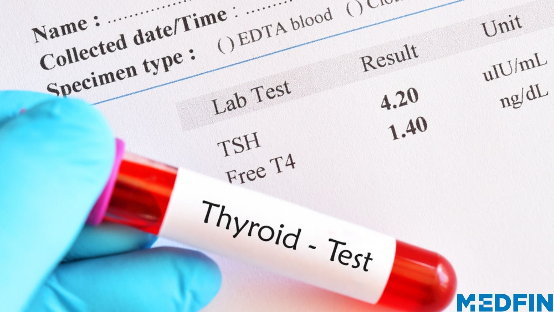 Thyroid: Diagnosis, Treatment and Recovery Explained