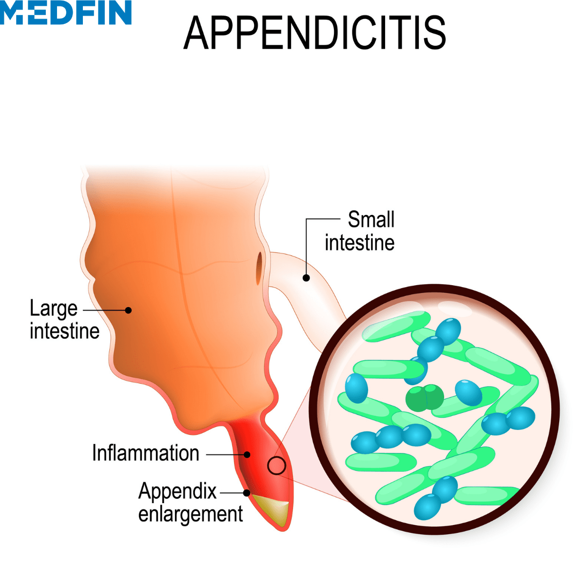 Medfin BlogAppendicitis – Diagnosis, Treatment and Recovery - Medfin Blog