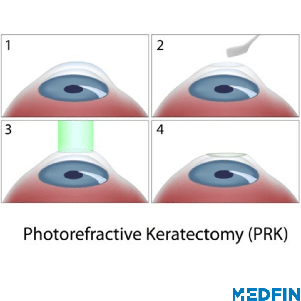 What is PRK Surgery? - Medfin