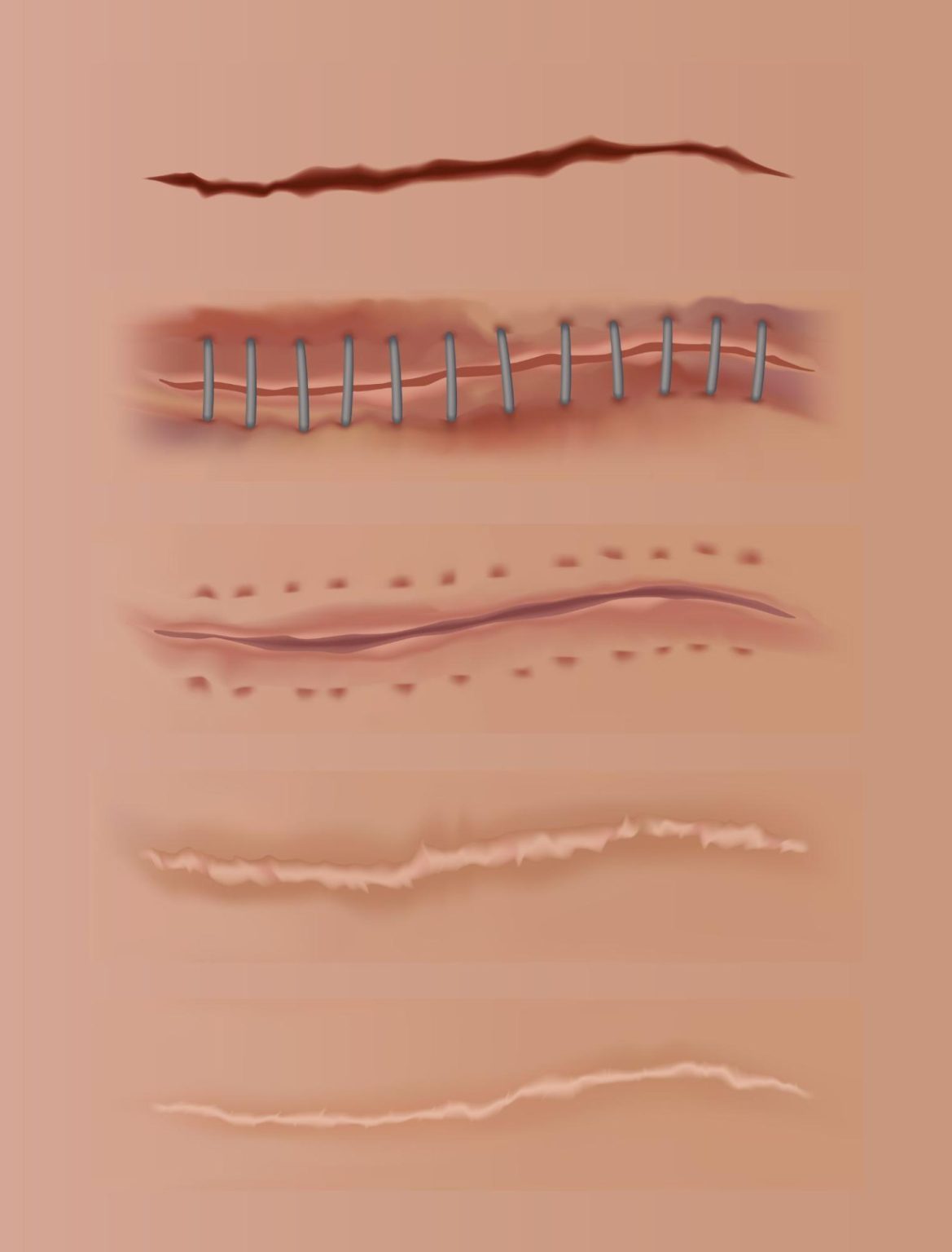 Scar Tissue Formation After Gynecomastia Surgery: Is it Normal?|Medfin